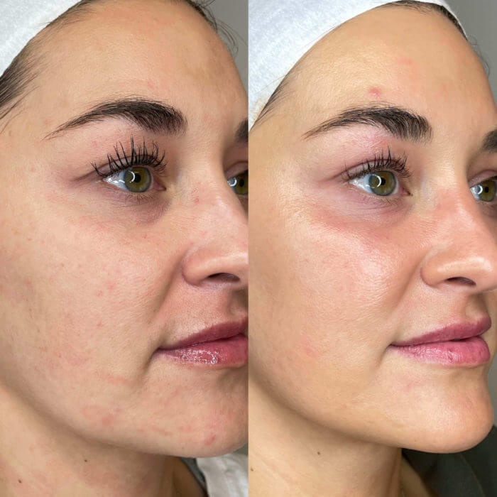 Medspa Treatment Gallery | Gig Harbor Aesthetics in WA