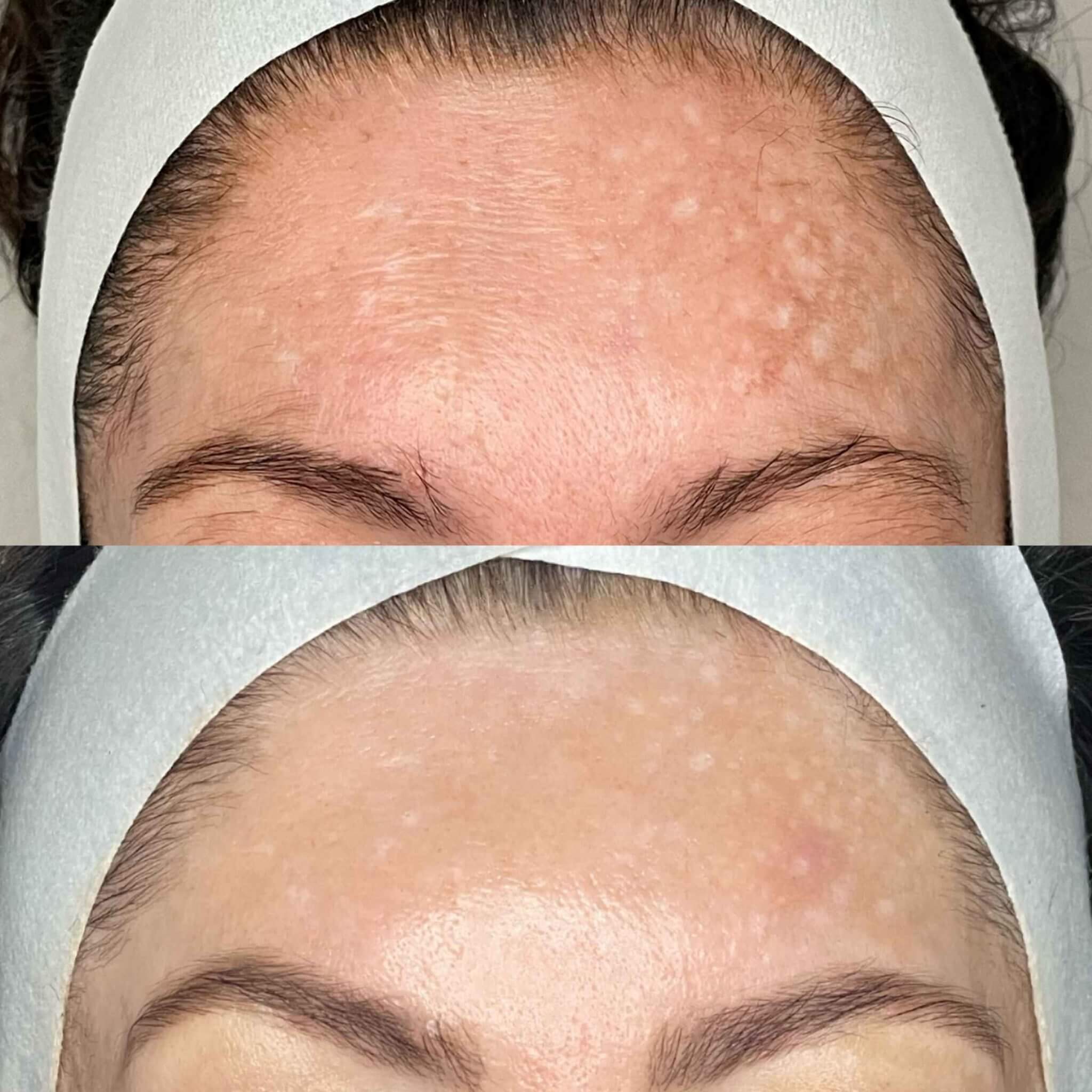 Medspa Treatment Gallery | Gig Harbor Aesthetics in WA